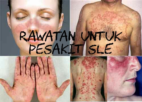 Healthy Lifestyle Secrets: RAWATAN UNTUK PESAKIT SLE