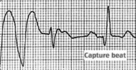 Identifying Arrhythmias (Part-2)