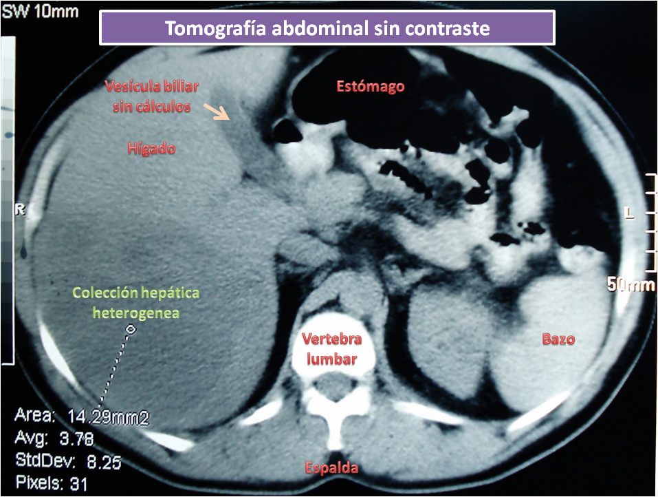 Soluciones Quirúrgicas: ¿Qué es un absceso hepático?