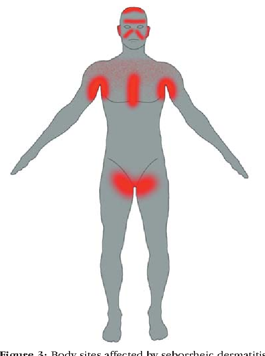 Medical for Us: Seborrheic Dermatitis and Dandruff