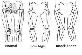 My Bilateral Total Knee Replacement And Addiction Experiences: BOW LEGS ...