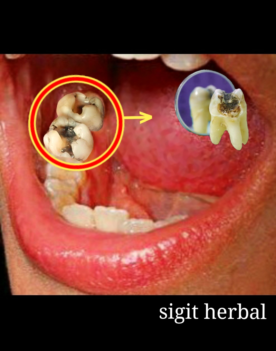 Traditional medicine for toothache