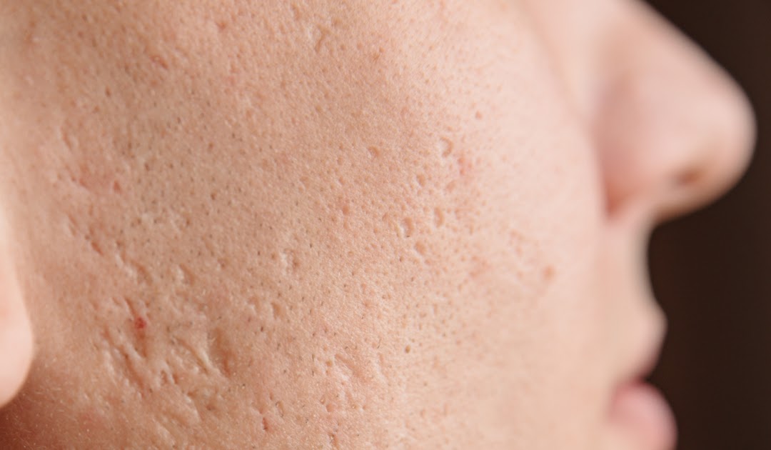 Vermijd littekens na puistjes | Apotheek Meysen - Peer