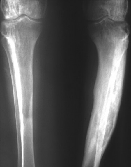 como osteíte deformante