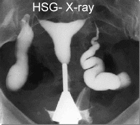 Thoughts on Infertility: HSG Results