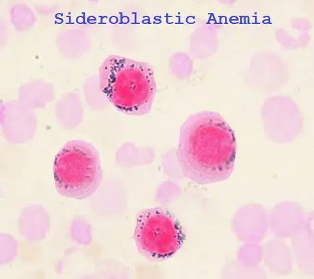 Sideroblastic Anemia Peripheral Smear