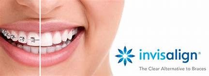 Invisalign- Clear aligners