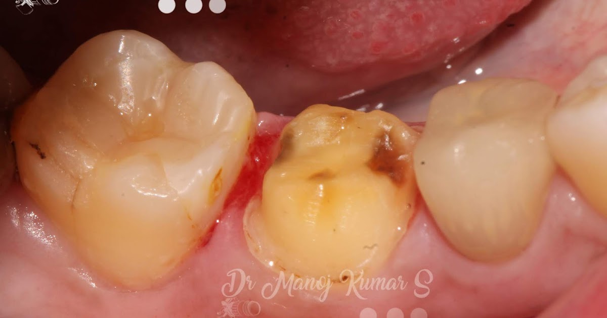 Case 45: Cementation protocol for an emax- lithium disilicate crown