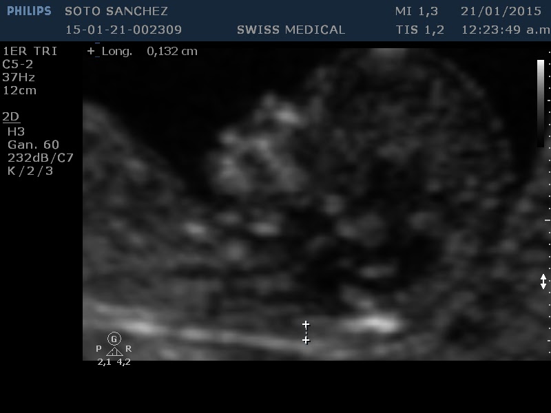 Que es la traslucencia nucal?
