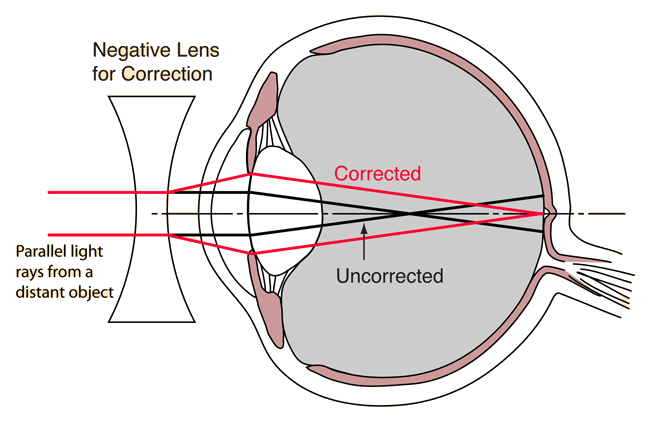 Myopia (Nearsightedness)