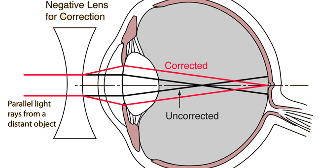 Myopia (Nearsightedness)