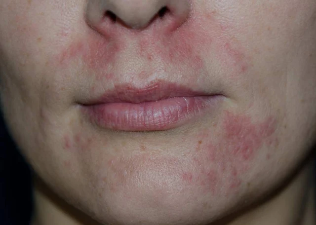 Remèdes Maison pour la Dermatite Périorale ~ Remèdes Maison