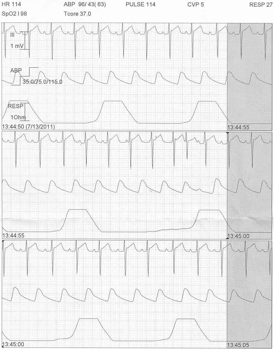 Pedi cardiology: EP - Isorhythmic Dissociation
