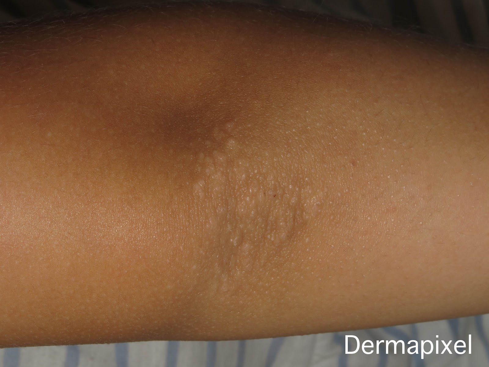 Idealmente oasis Príncipe piel atopica codos Enderezar brillante Glamour