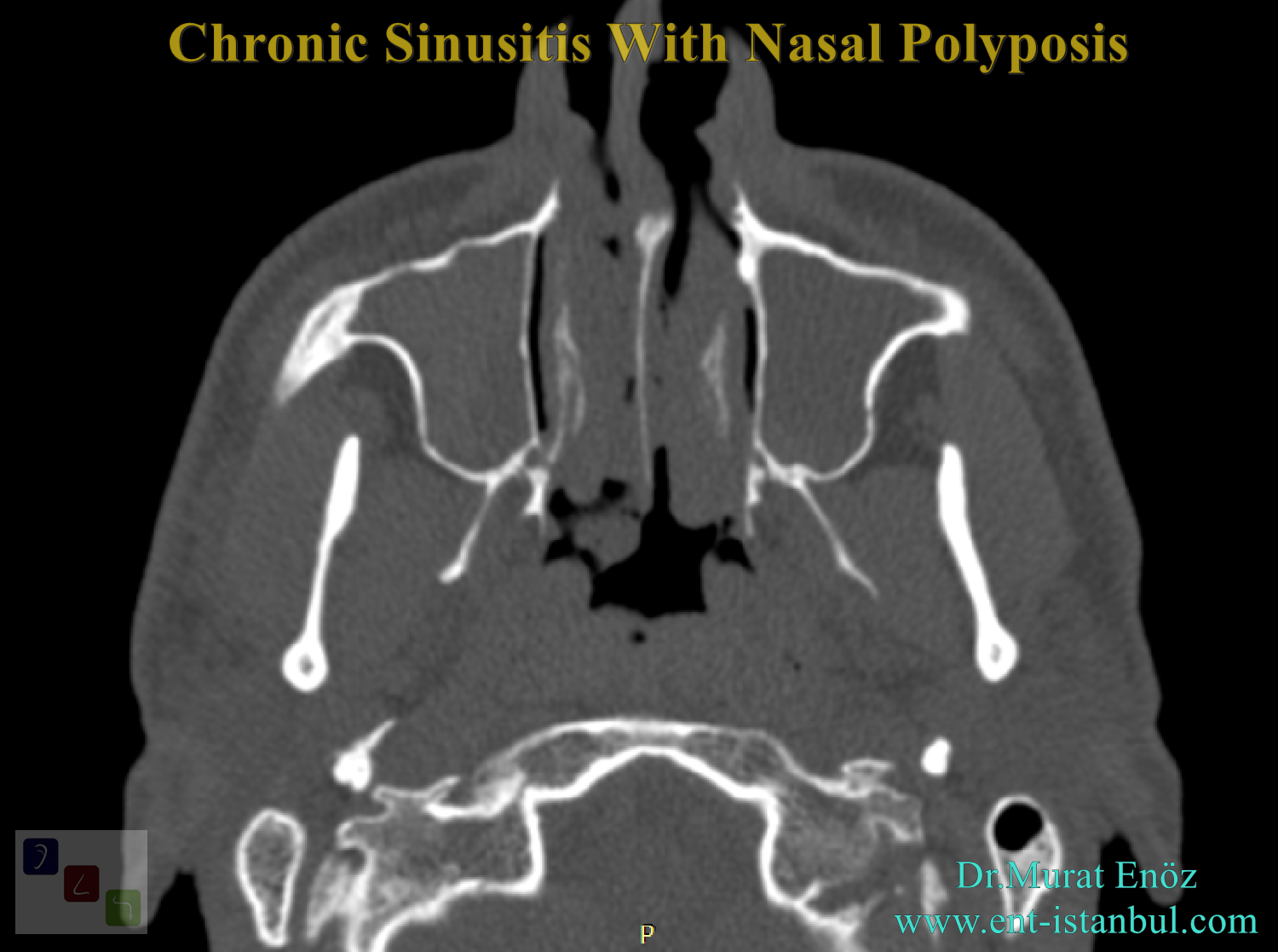 Health Zone Turkey: In Which Situations Is Paranasal Sinus Tomography ...