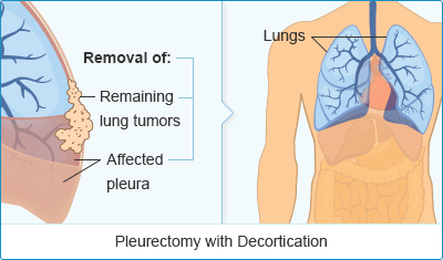 Pleurectomy Decortication Is Effective Handling For Mesothelioma Cancer ...