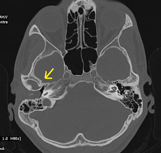 Aural Polyp- CT - Sumer's Radiology Blog