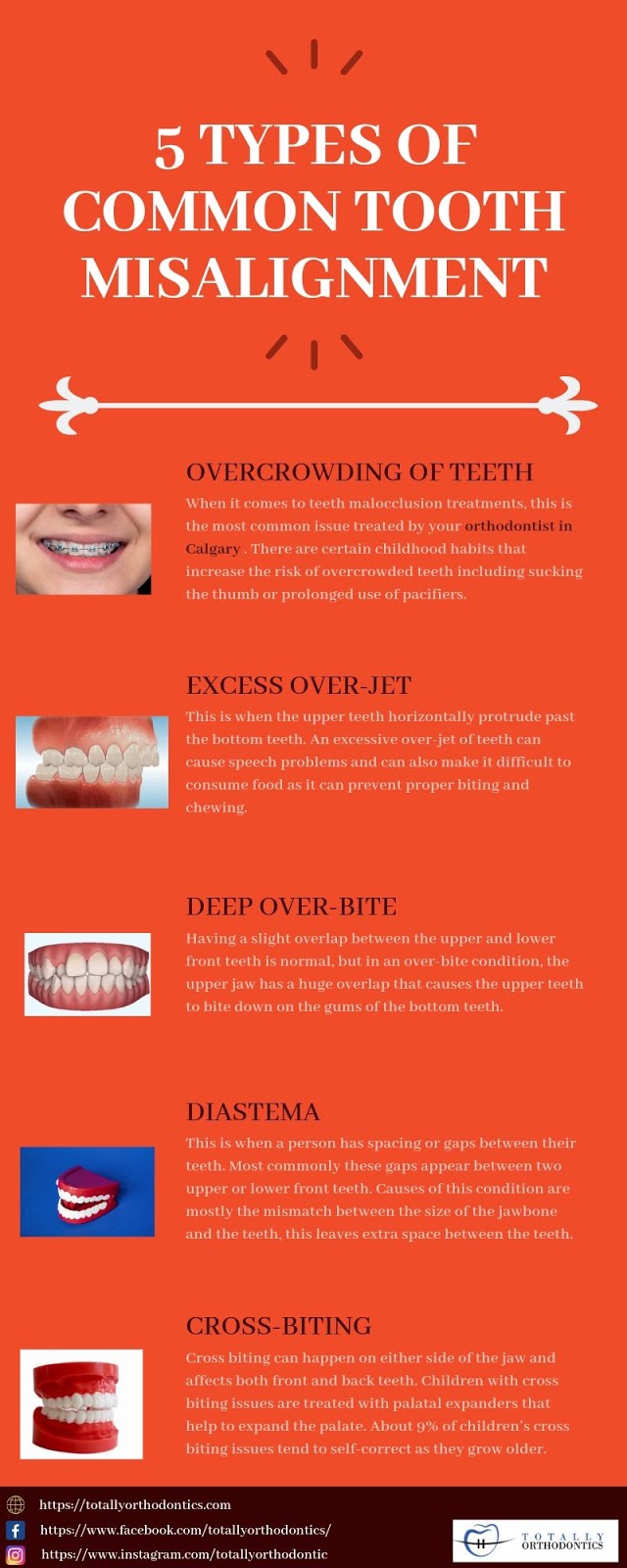 5 Types of Common Tooth Misalignment