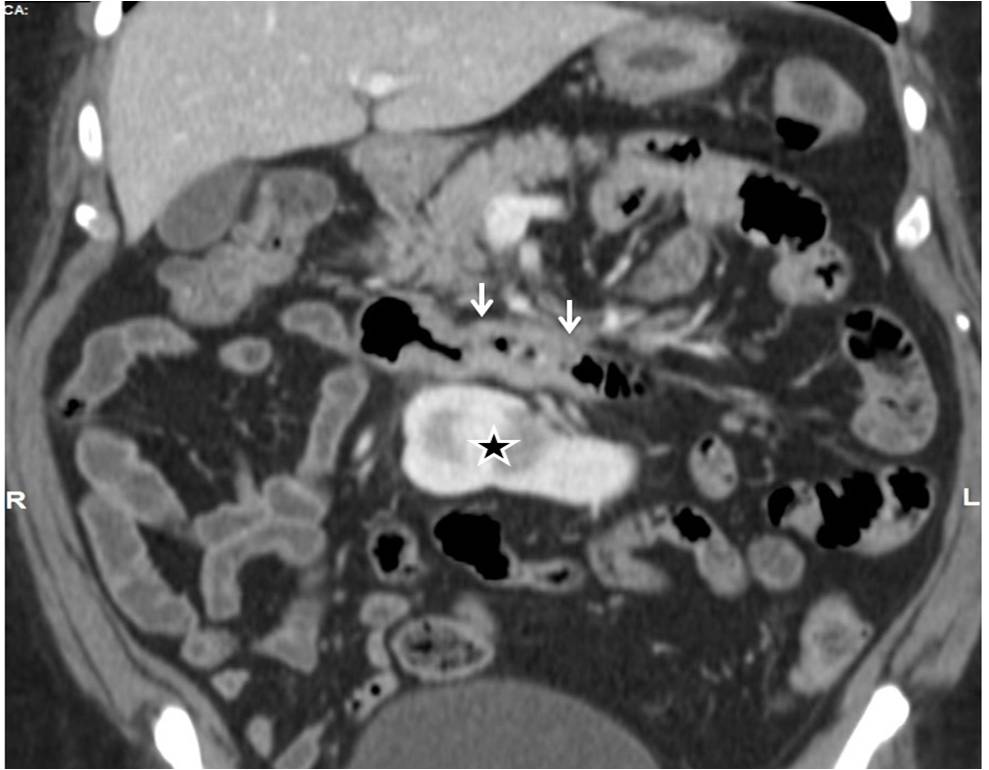 Surgery for GastroIntestinal (GI) Cancers: Cancer of distal duodenum ...