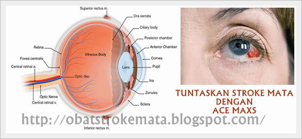 OBAT STROKE MATA