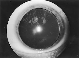 Medical Treatment Pictures-for Better Understanding: Conradi-Hunermann ...