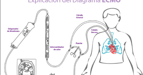 OXIGENACIÓN POR MEMBRANA EXTRACORPOREA: VENTILACION MECANICA