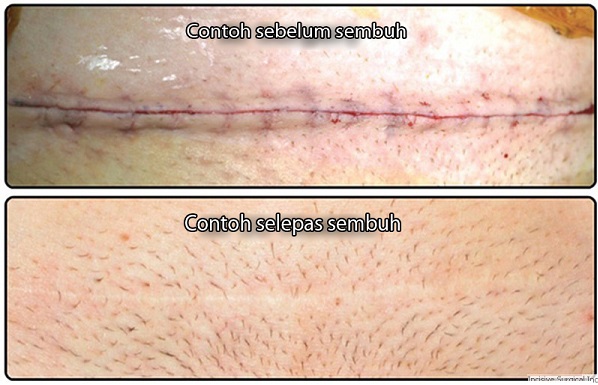 Petua Hilangkan Parut Czer & Pembedahan