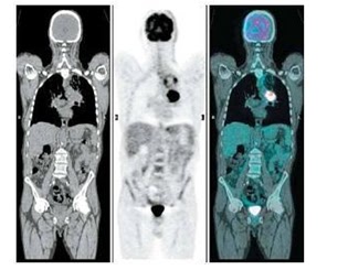 TPE sur le cancer du poumon: Dépistage