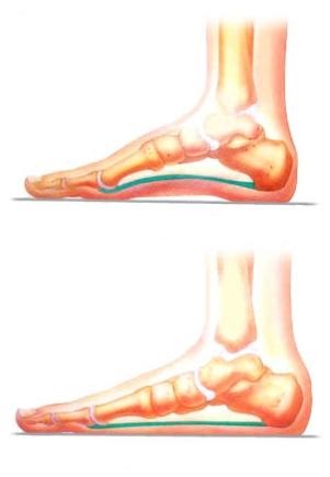 Vino lantio tuottaa ongelmia jalka/pakaratreenissä. Toinen pakara ...