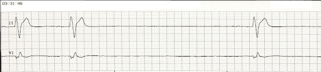 EKG Rhythm Strip Quiz 44
