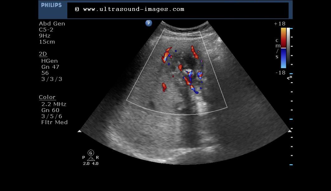 cochinblogs: Ultrasound imaging of gallbladder mass