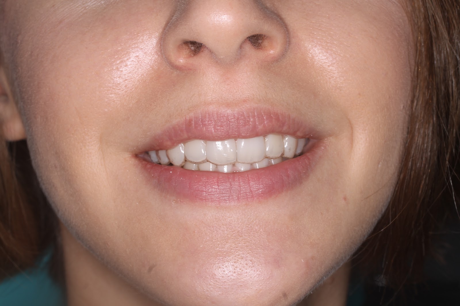 Richard Charon BDS: "Snaggle Teeth" to Lovely Smile with Invisalign®