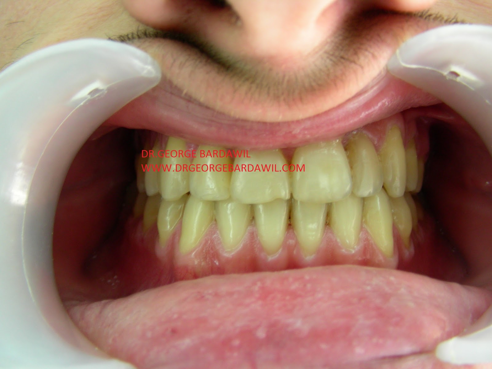 Dr.George E. Bardawil-Orthodontist-Invisalign Diamond level : Anterior ...