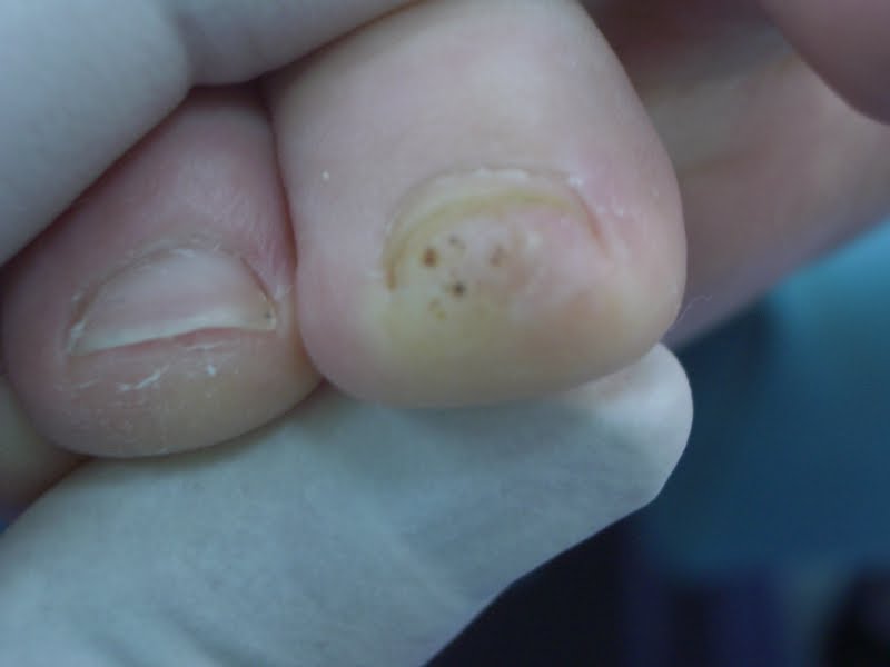 Podo Basas al Día: Quemadura por callicida. Papiloma en pulpejo de dedo ...