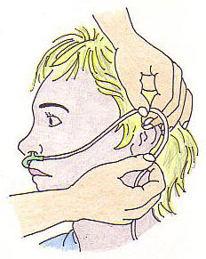 Administración de Oxigenoterapia por Cánula Nasal