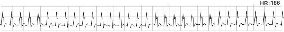 Belajar EKG PREMATURE JUNCTIONAL COMPLEX (PJC), JUNCTIONAL RHYTM ...
