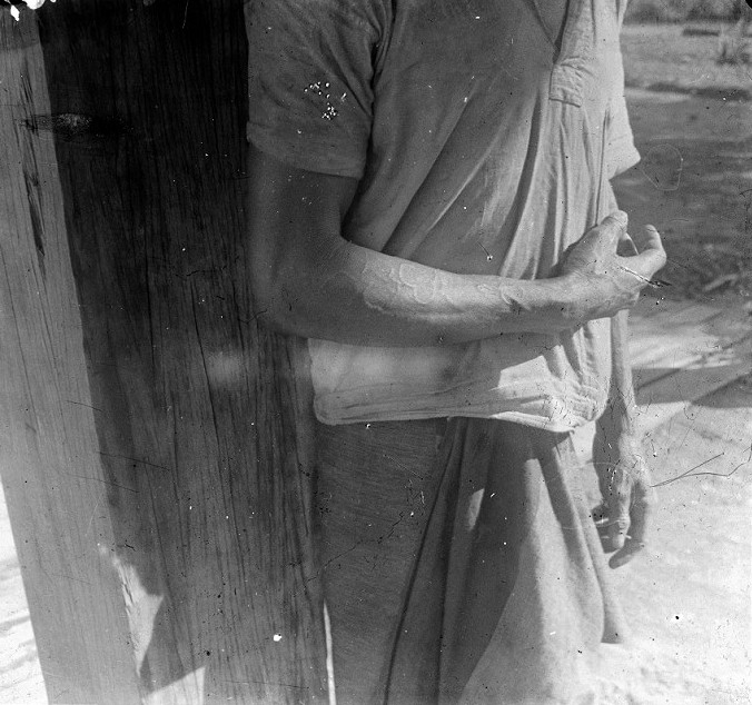 Prof. Dr. W.A.P. Schüffner Melakukan Penelitian ke Karo