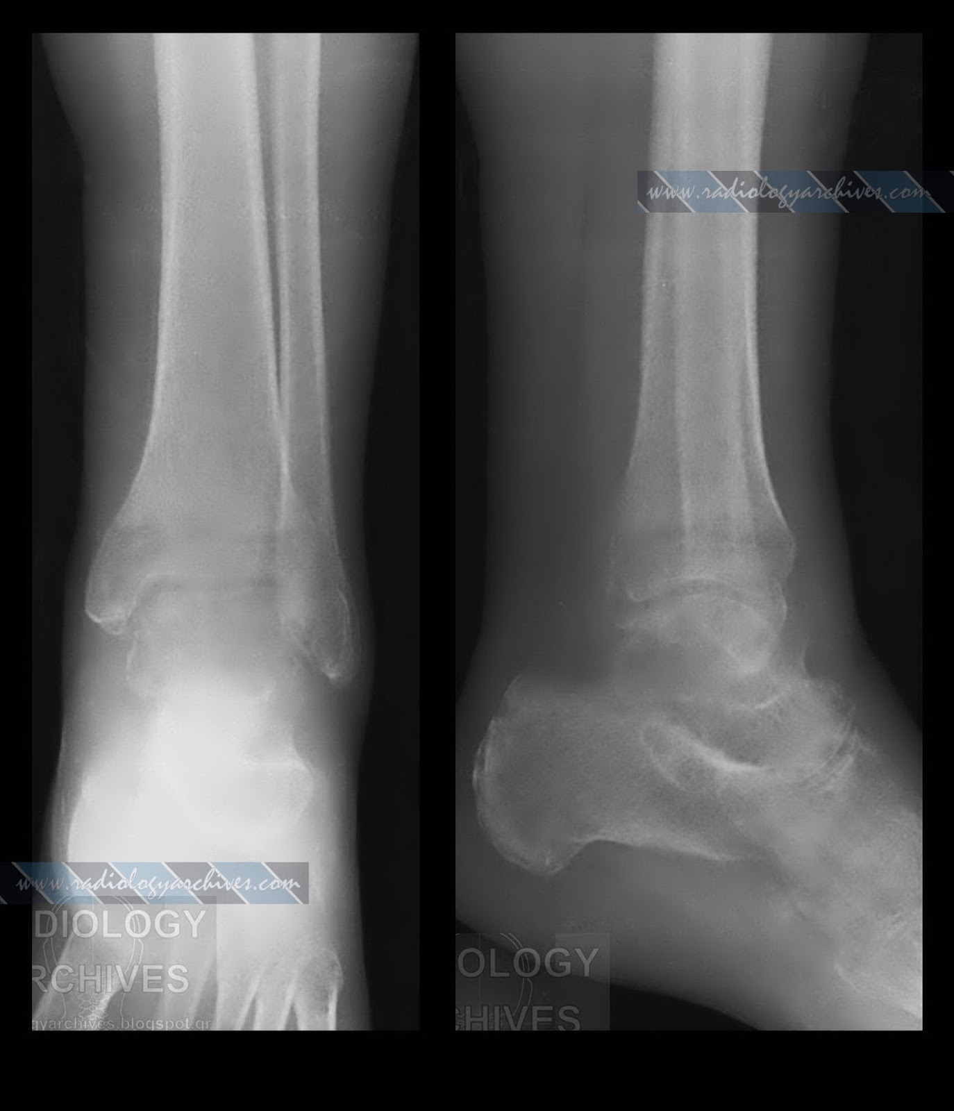 Radiology Archives: Ατροφία Sudeck