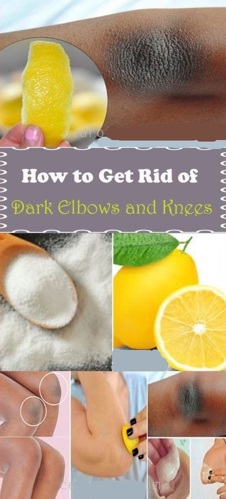 How to Get Rid of Dark Elbows 2019 NEWS - Healthy Lifestyle