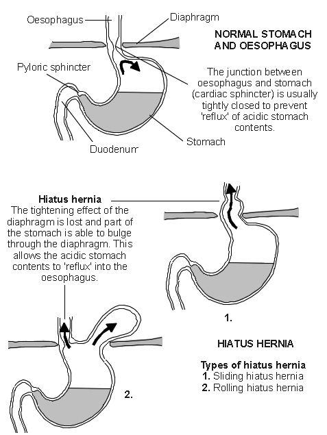 Hiatus Hernia Info: How you can Heal a new Hiatus Hernia