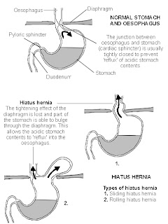 Hiatus Hernia Info: How you can Heal a new Hiatus Hernia