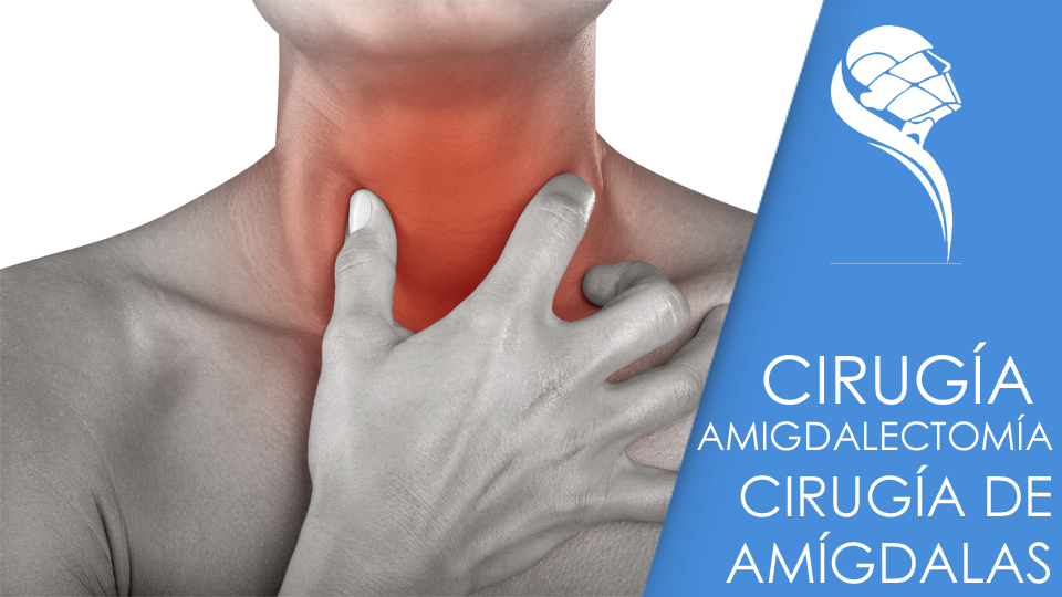 Otorrinolaringólogo en Guadalajara, Jalisco: AMIGDALECTOMÍA