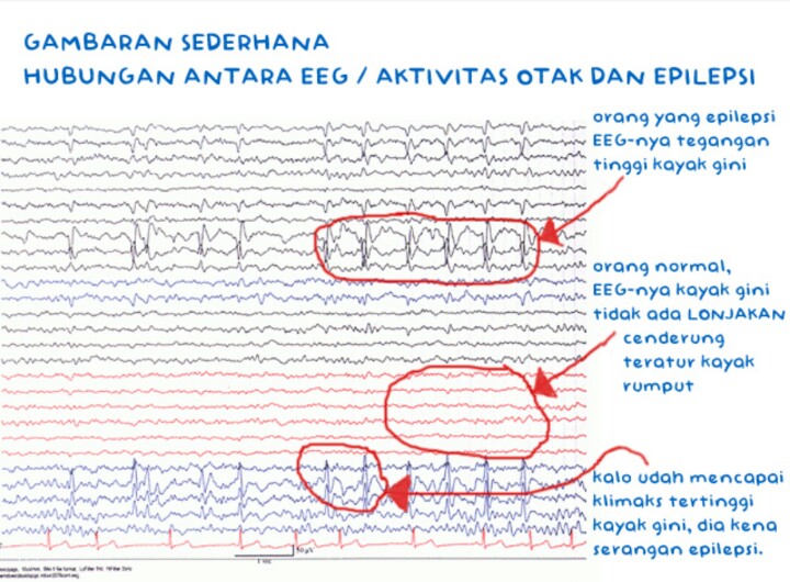 Epilepsi dan West Syndrome - kartikanugmalia.com