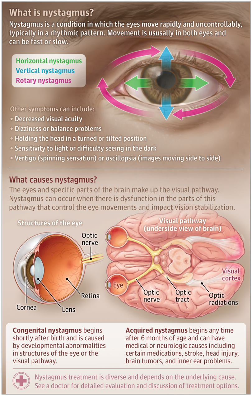 ZONA DE SALUD DE OFRA: Jama. Nistagmus.