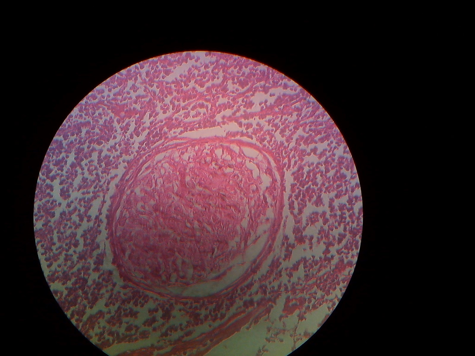 Ca - CaDo (Catatan Calon Dokter): Blok 11 : Praktikum Patologi Anatomi ...