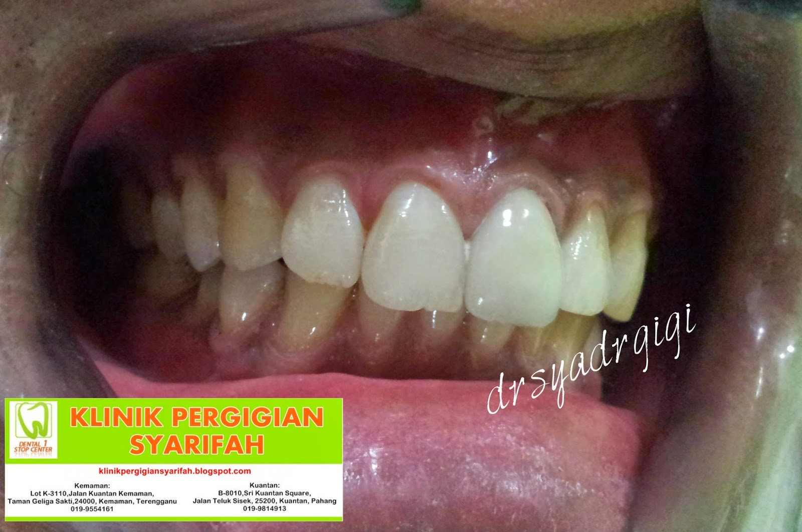 KLINIK PERGIGIAN SYARIFAH: GIGI DEPAN YANG BERMASALAH-GIGI TAK SAMA PANJANG