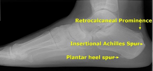 Central Massachusetts Podiatry: Plantar Fasciitis (a.k.a. Heel Spur ...