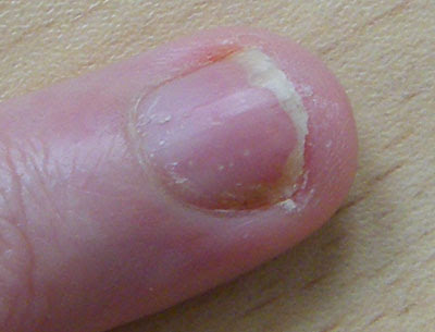 What Is All: Nail Pitting: A Disorder of Nails