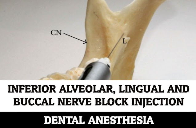 DENTAL ANESTHESIA: Inferior Alveolar, Lingual and Buccal Nerve Block ...