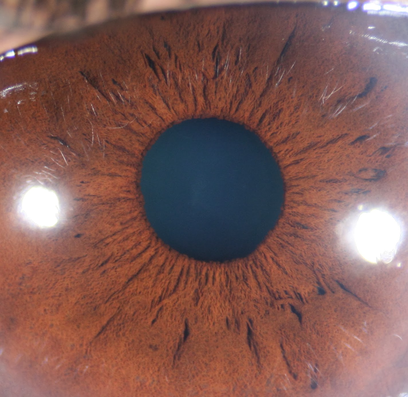 Modern & Multidimensional Iridology: Crypt, Defect Sign & Lacuna ...